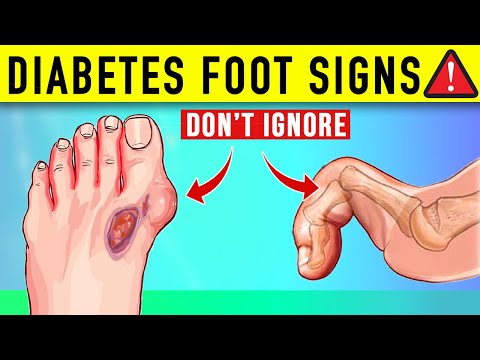 10 Must Know Signs Your Feet Tell You About Diabetes! – Healthy Living